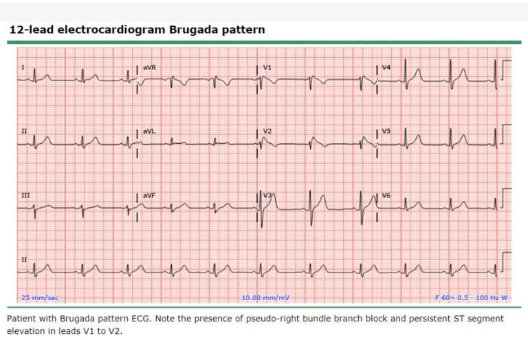 Caso Clínico #02 - Síndrome De Brugada Dr. Rafael Vinicius Otsuzi