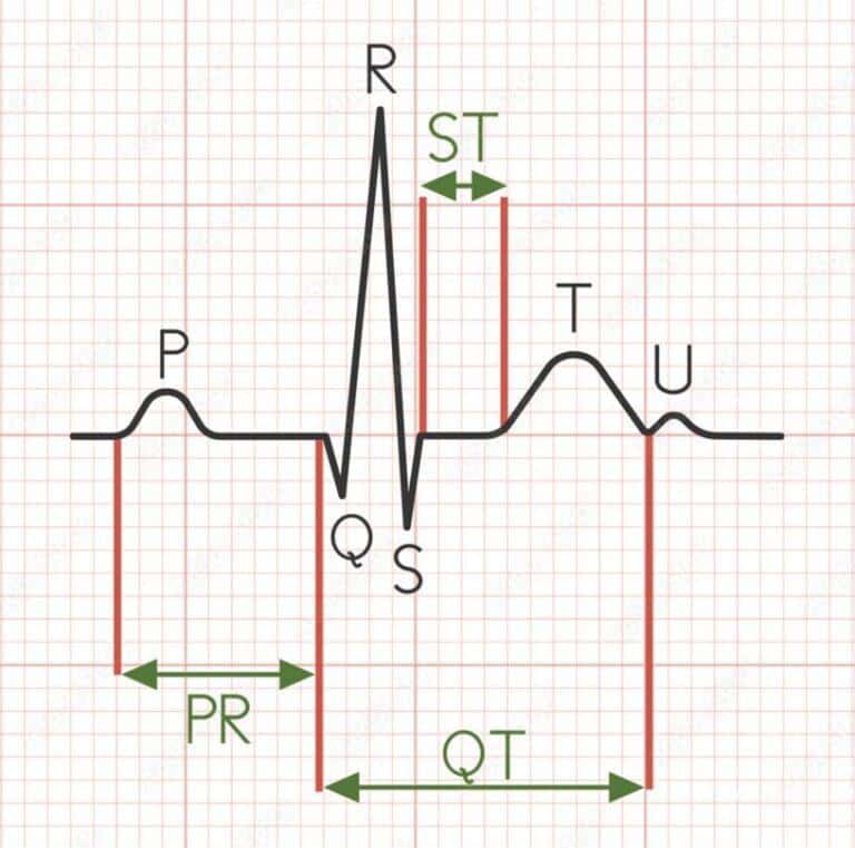 Intervalo QT: Por Que é Importante Entender Sobre Ele? Dr. Rafael ...