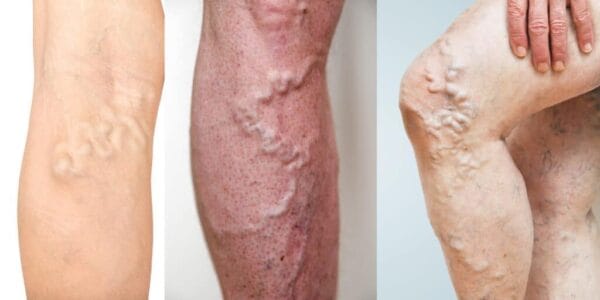 Rombose Venosa: O Que é, Tipos, Complicações E Tratamento