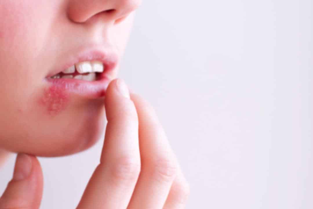 Herpes Simples: O Que é, Sintomas E Tratamento